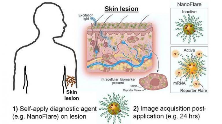 Topical Nanotechnology Diagnoses Skin Disease - Cleanroom Connect